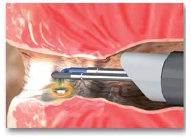 PlasmaButton | Olympus America | Medical